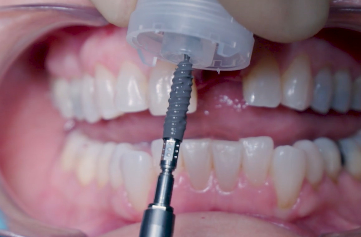 Immediate implant placement and restoration in fractured incisor with ...